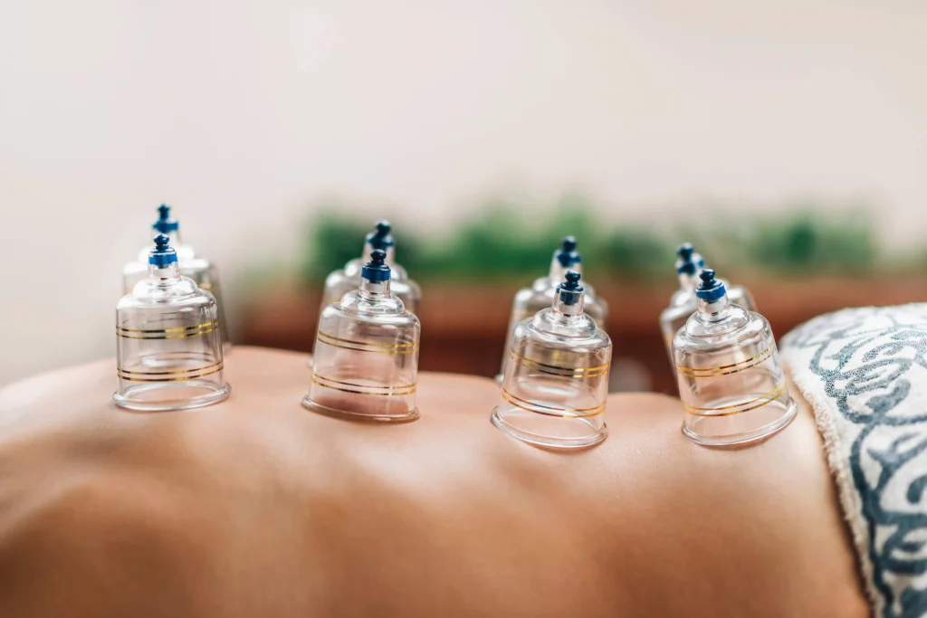 Cupping - Fēng Shén zhī Dào Acupuncture and Chinese Medicine
